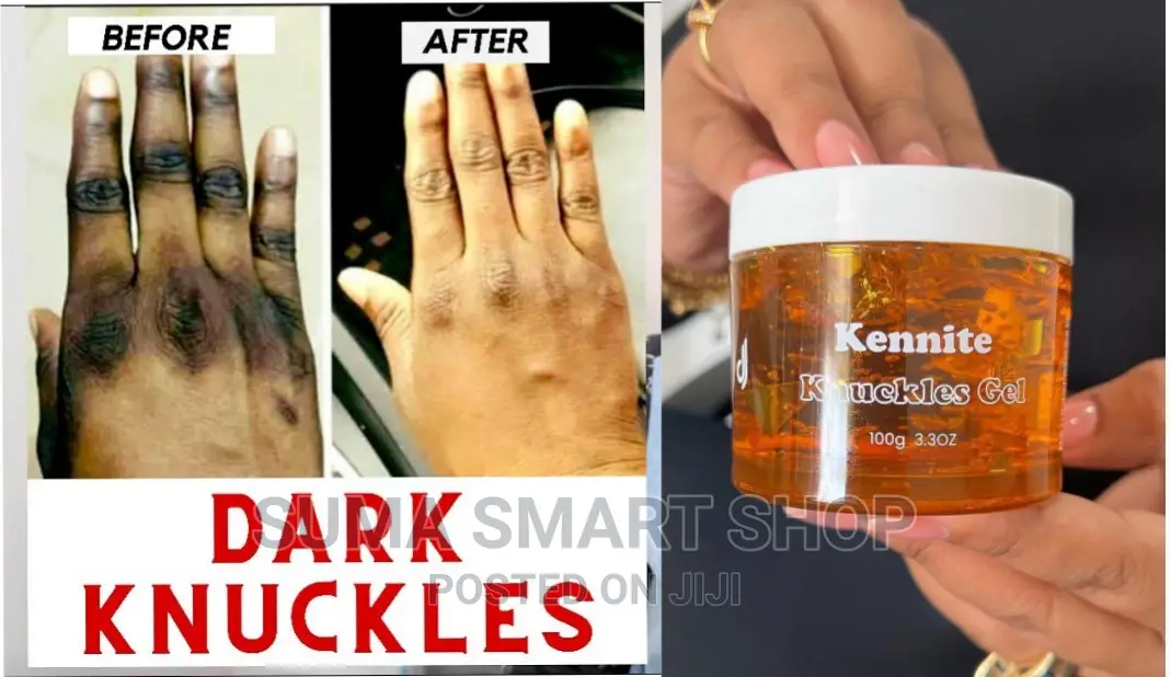 KENNITE Knuckles Gel . (Ondoa Madoa Vidoleni ) in Ilala - Face Care ...